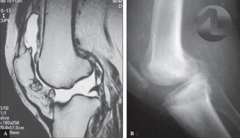 O que é Derrame Articular, ou Água no Joelho - Especialista do Joelho ...