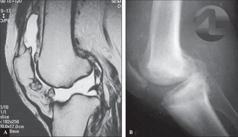 O que é Derrame Articular, ou Água no Joelho | Especialista do Joelho
