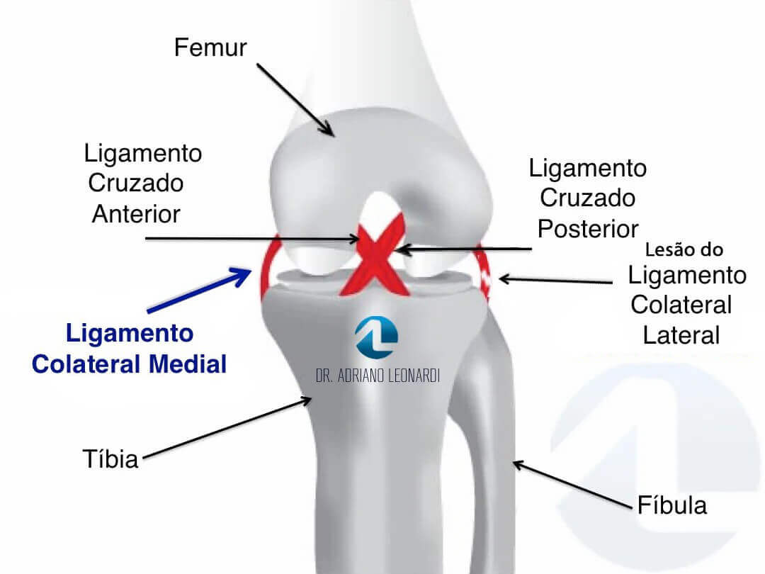 O que é a Lesão do Ligamento Colateral Medial - LCM - Especialista do ...