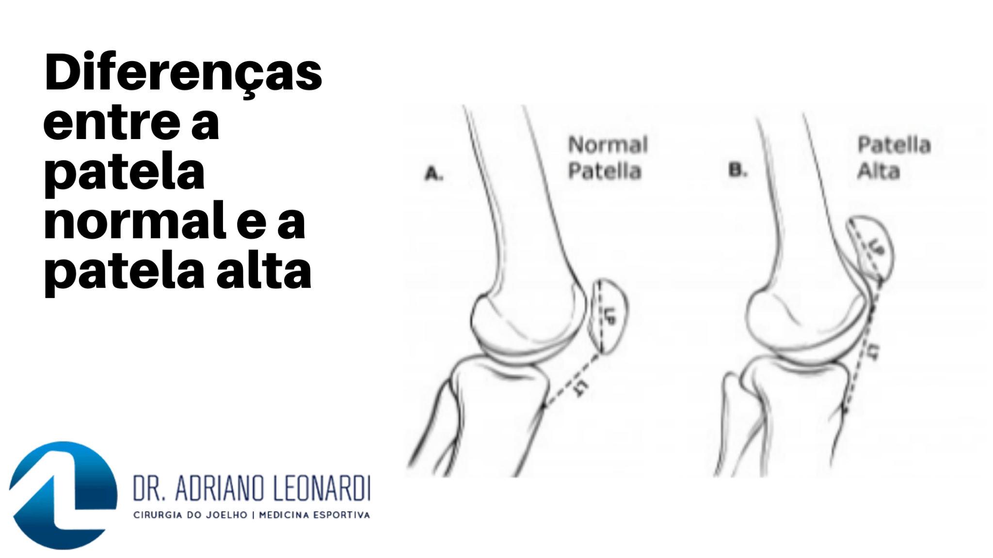 Patela alta tem cura? Preciso rebaixar? O que fazer? - Especialista do ...