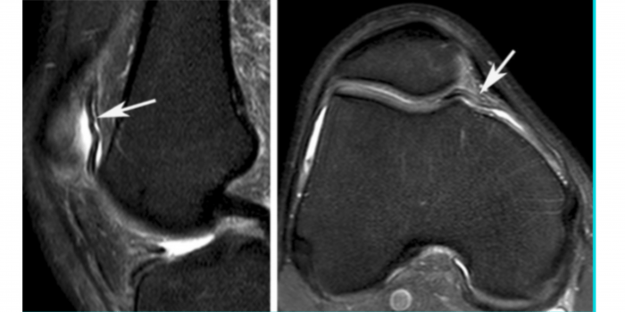 Síndrome da Plica Sinovial no Joelho: sintomas, diagnóstico e tratamento