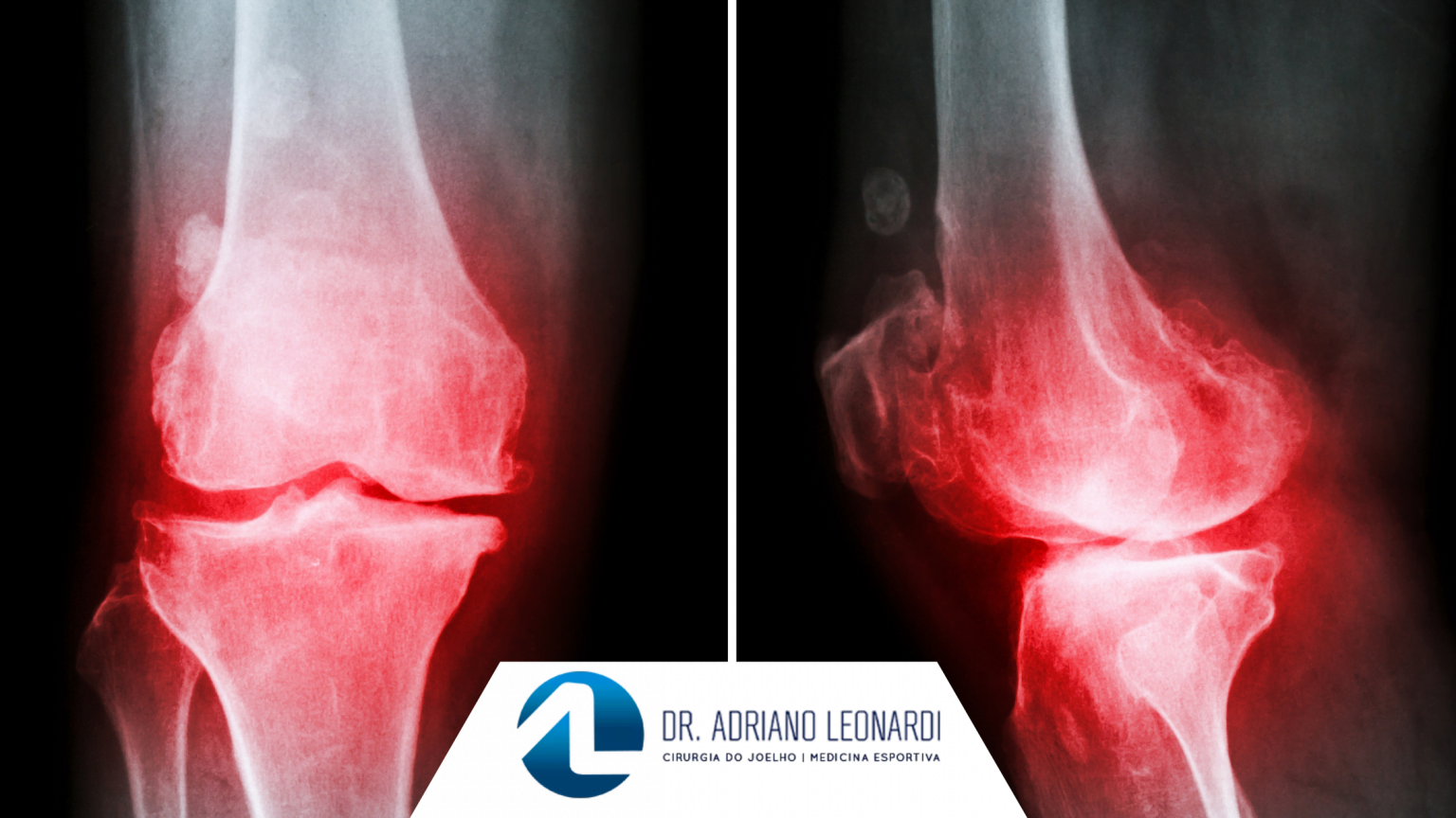 Exercícios para artrose: como fortalecer com dor?