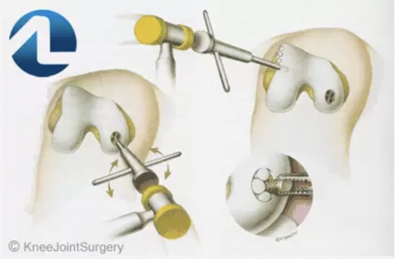 Cirurgia para artrose de joelho, como é feita e quando é indicada?