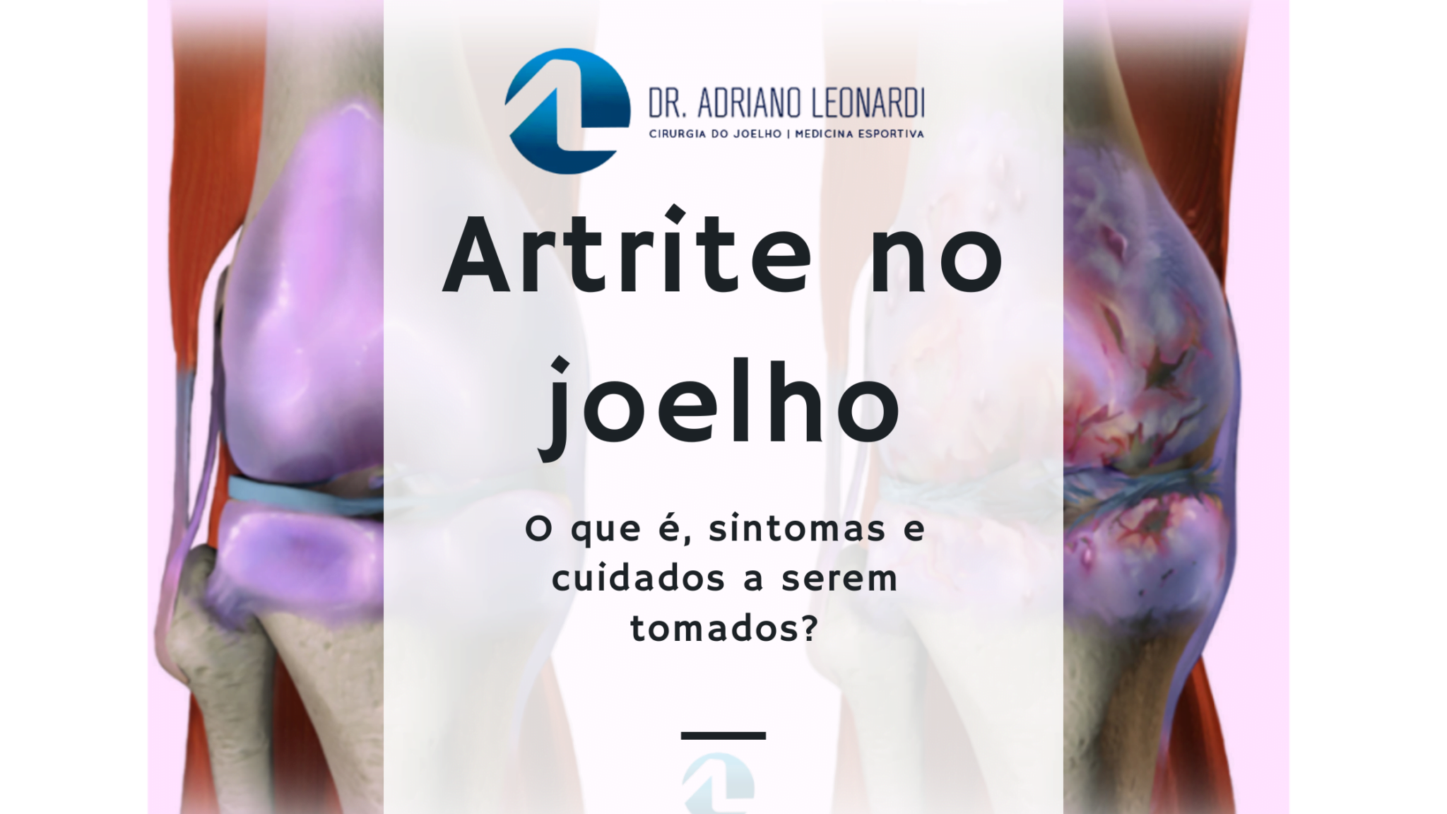 Sinovite vilonodular no joelho, o que é, tratamento e que médico procurar?