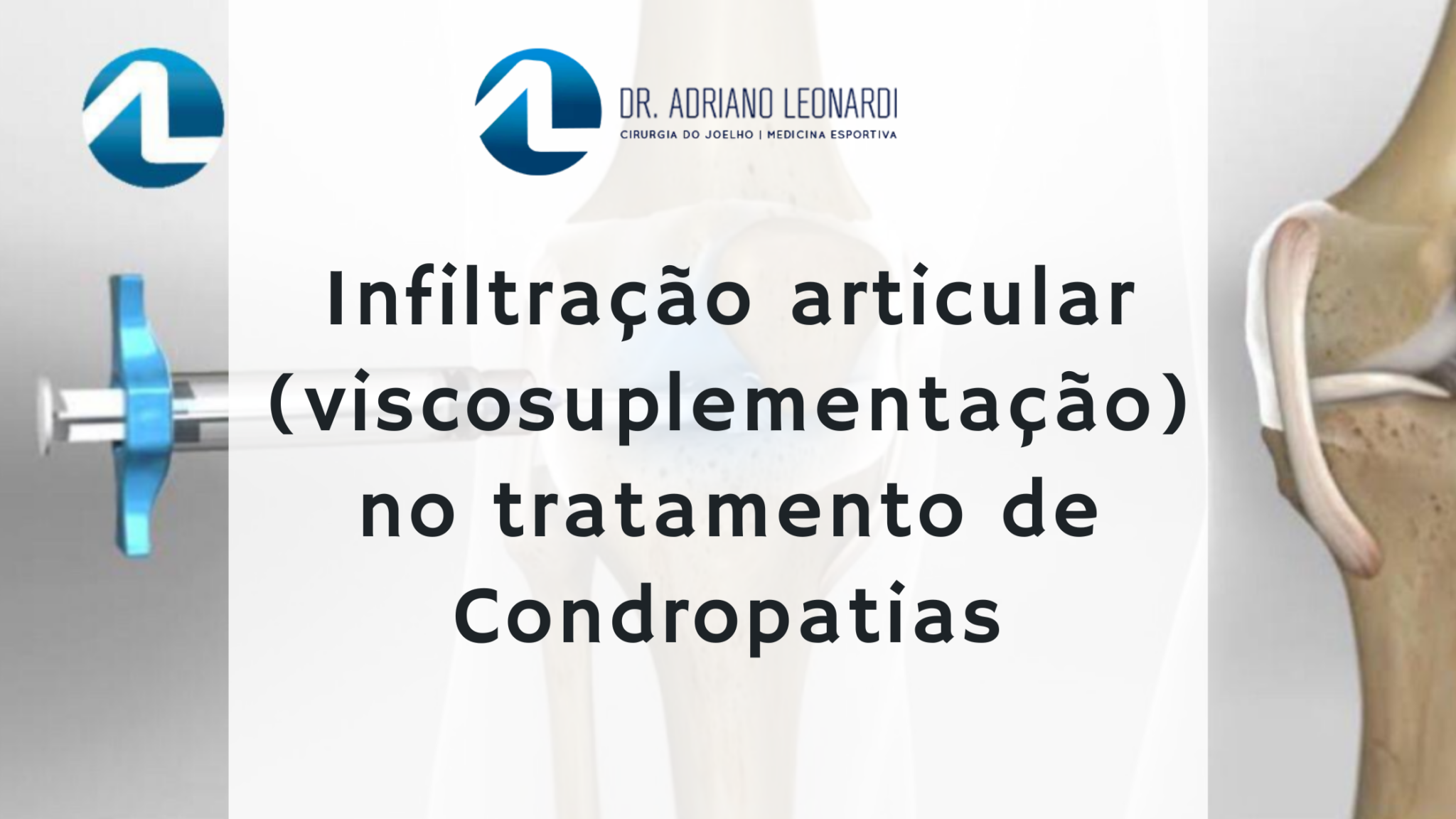 O que é condropatia - Especialista do Joelho | Dr. Adriano Leonardi