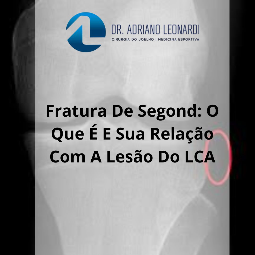 Fratura de Segond: o que é e sua relação com a lesão do LCA ...